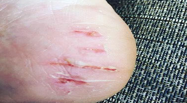 How to prevent swim fin cuts and blisters – eBodyboarding.com